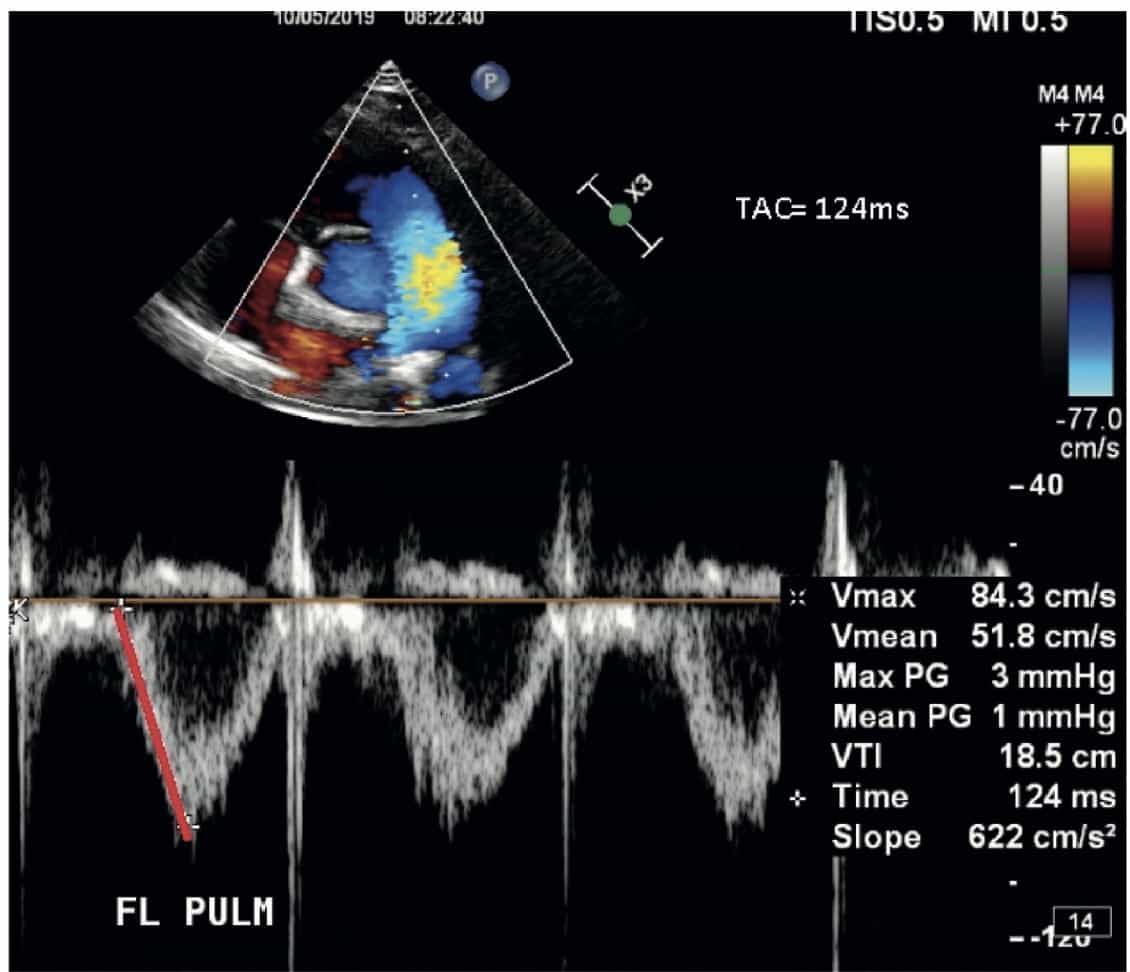 Como calcular a PSAP na ausência de refluxo tricúspide? - Blog Ecope
