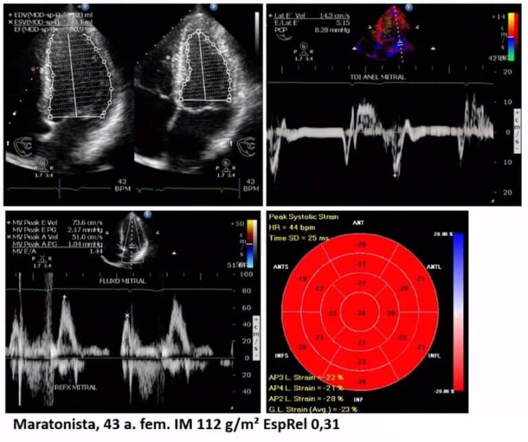 Como funciona a aplicação prática do Strain no Diagnóstico Diferencial ...