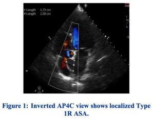 O que é Aneurisma do Septo Interatrial? - Blog Ecope