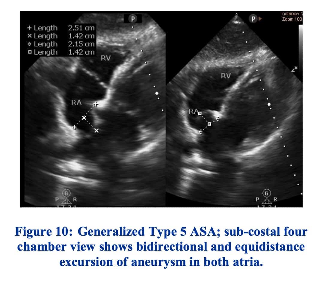 Aneurisma Do Septo Interatrial é Perigoso - RETOEDU