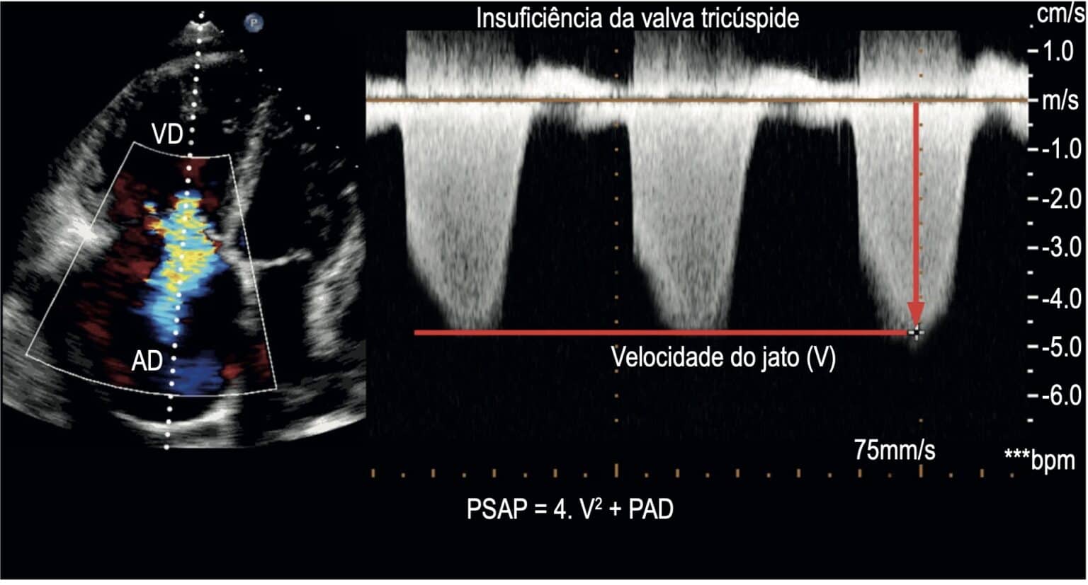 Como calcular a PSAP na ausência de refluxo tricúspide? - Blog Ecope