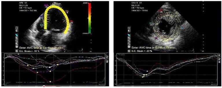 Como funciona a aplicação prática do Strain nas Valvopatias? - Blog Ecope