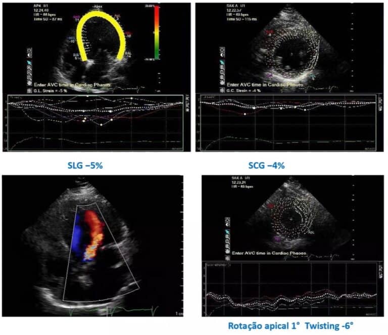 Como funciona a aplicação prática do Strain nas Valvopatias? - Blog Ecope
