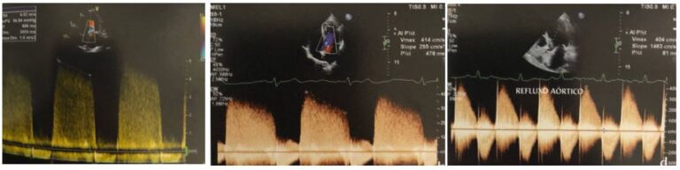 Insuficiência Aórtica: aspectos ecocardiográficos - Blog Ecope