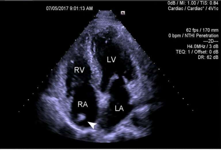 Anatomia Ecocardiográfica do Átrio Direito - Blog Ecope