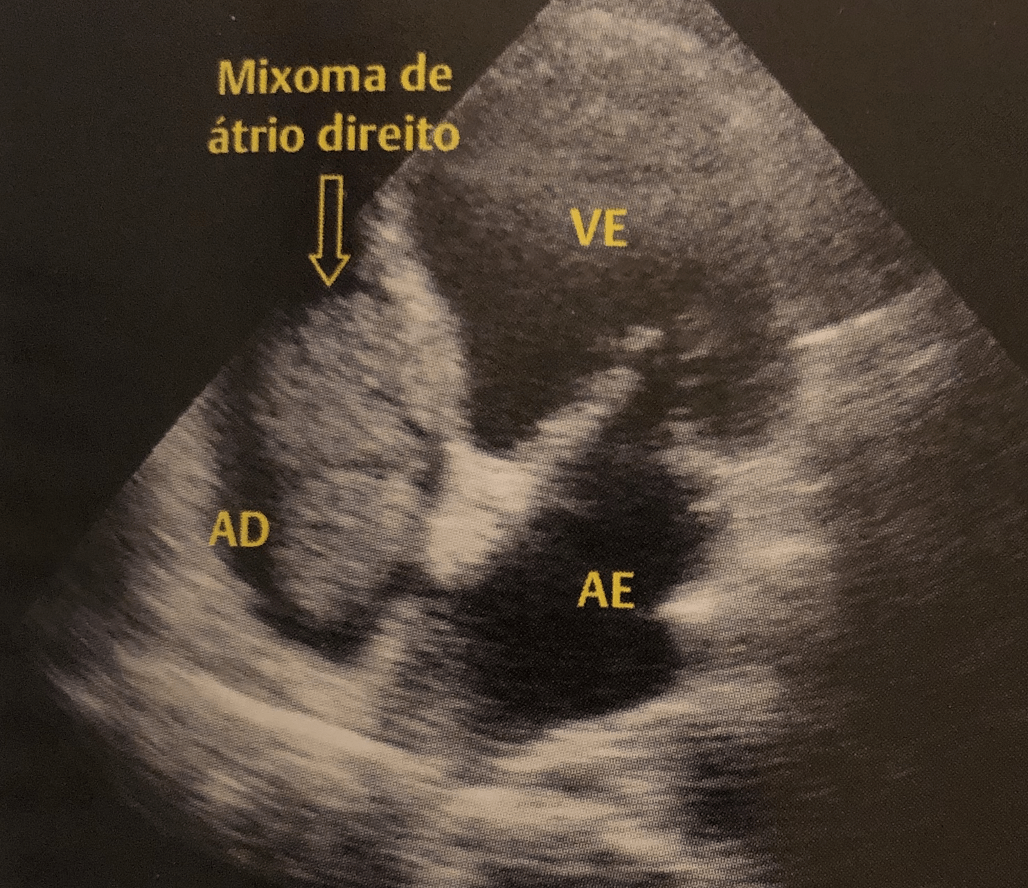 Tumores Cardíacos: mixoma - Blog Ecope