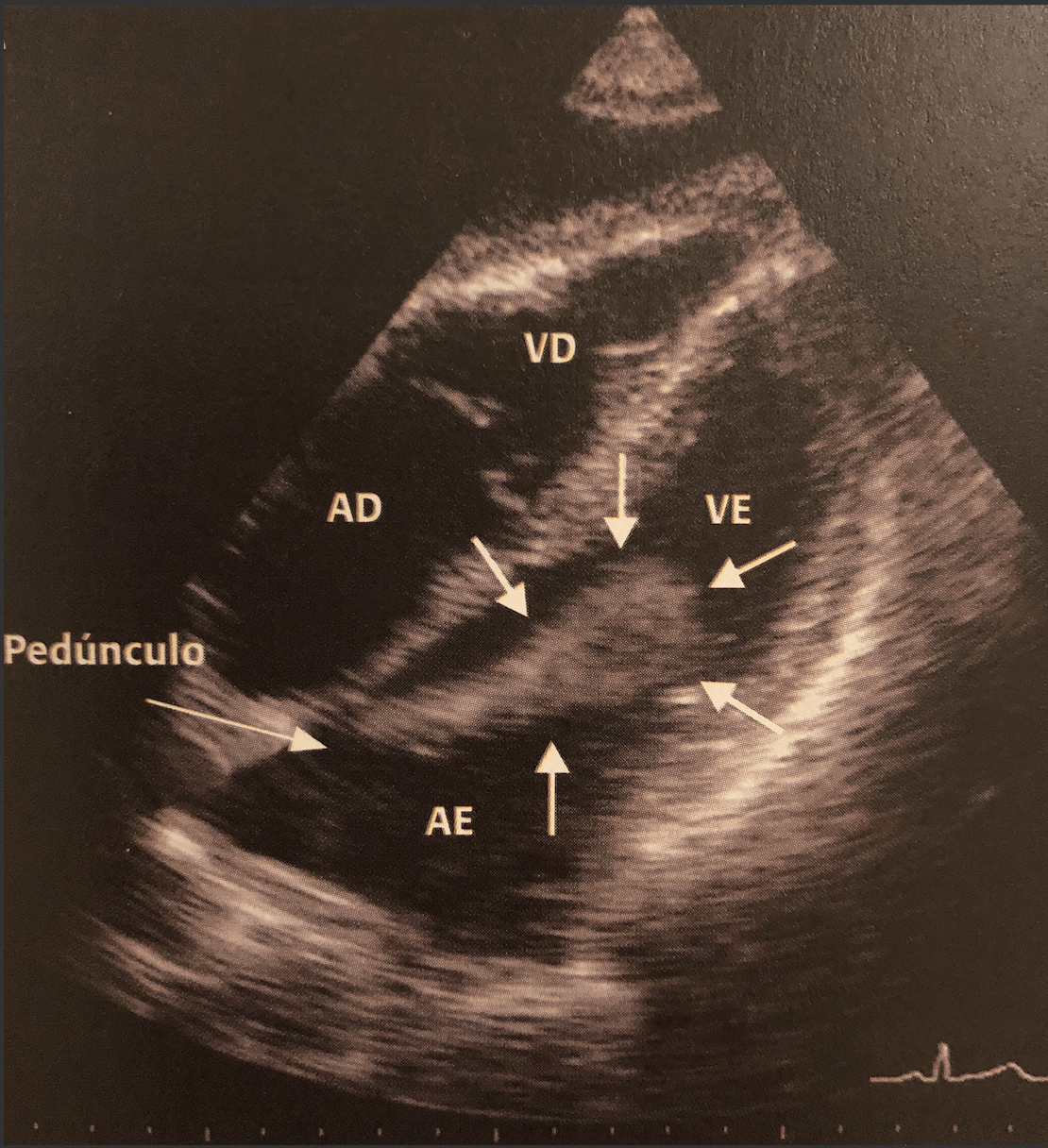 Tumores Cardíacos: mixoma - Blog Ecope