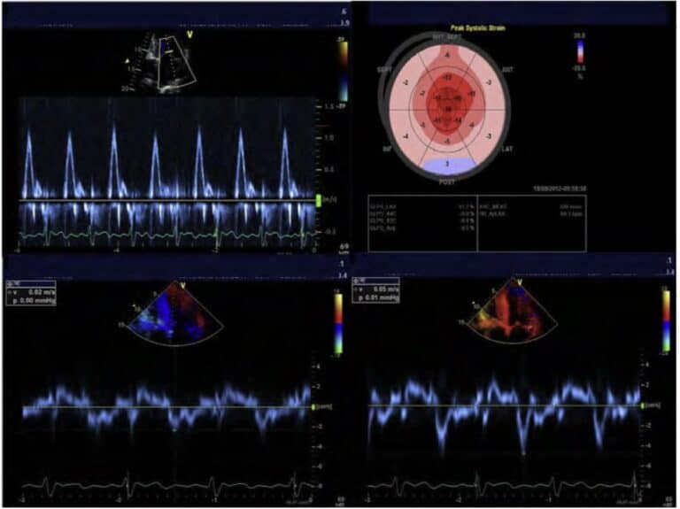 Avaliação da Função Diastólica em Pacientes com Cardiomiopatia ...