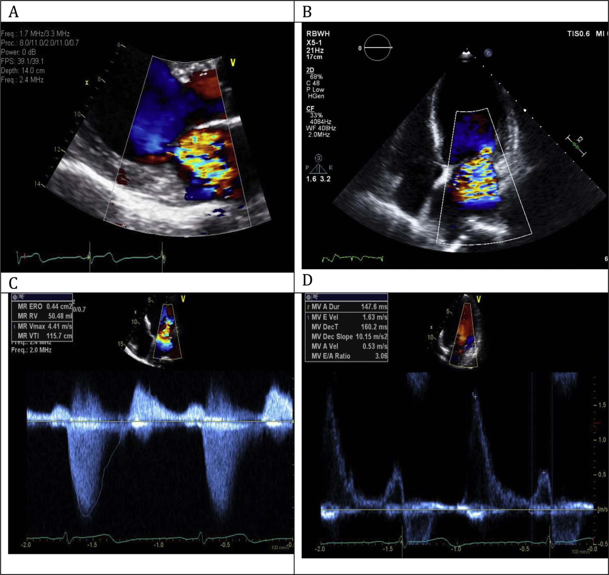 Valva Mitral com Folheto Único - Blog Ecope