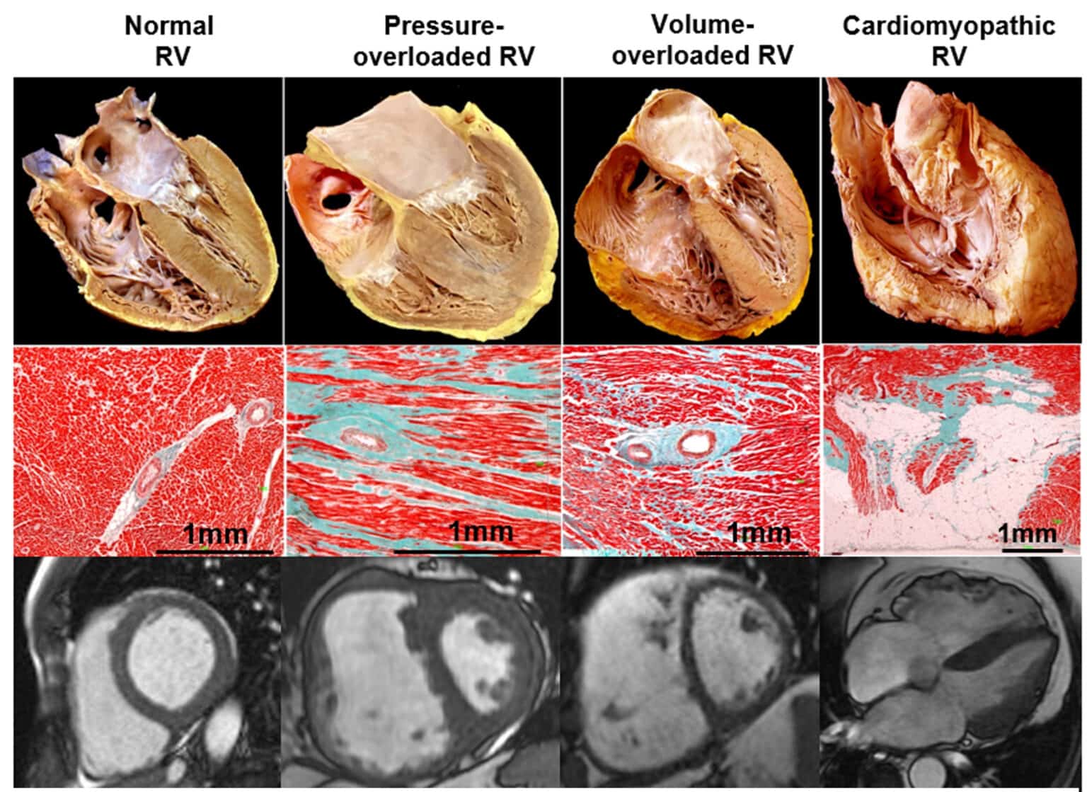 VENTRÍCULO DIREITO: COMO AVALIAR – Parte 3 - Blog Ecope