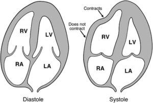 McConnell’s Sign: um importante achado ecocardiográfico - Blog Ecope