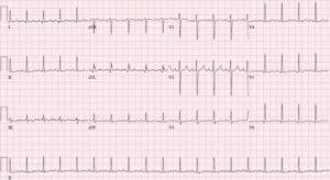 McConnell’s Sign: um importante achado ecocardiográfico - Blog Ecope