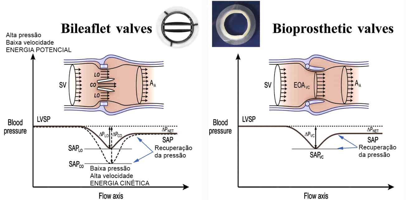 PRÓTESES EM POSIÇÃO AÓRTICA, PARTICULARIDADES - Blog Ecope