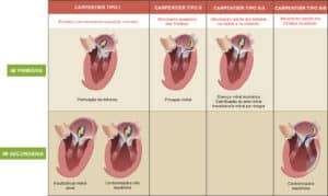 ENTENDENDO A CLASSIFICAÇÃO DE CARPENTIER PARA INSUFICIÊNCIA MITRAL ...