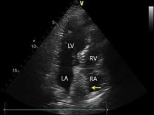 Hipertrofia Lipomatosa do Septo Interatrial: aspectos ecocardiográficos ...