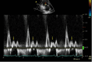 Onda L mitral – qual significado? - Blog Ecope