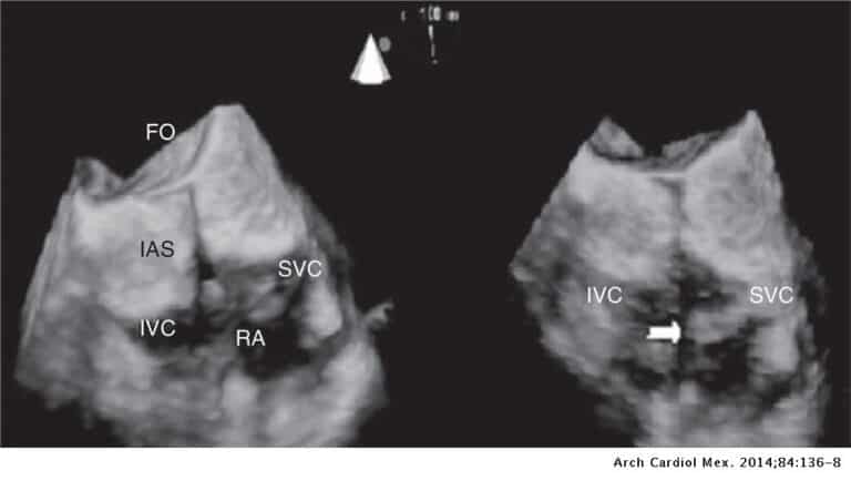 Hipertrofia Lipomatosa do Septo Interatrial: aspectos ecocardiográficos ...