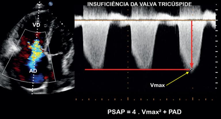 IDENTIFICAÇÃO ECOCARDIOGRÁFICA DA HIPERTENSÃO PULMONAR - Blog Ecope