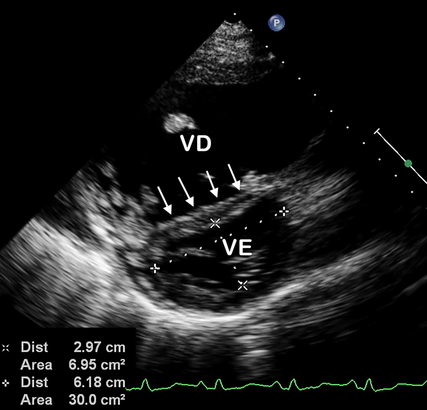 IDENTIFICAÇÃO ECOCARDIOGRÁFICA DA HIPERTENSÃO PULMONAR - Blog Ecope