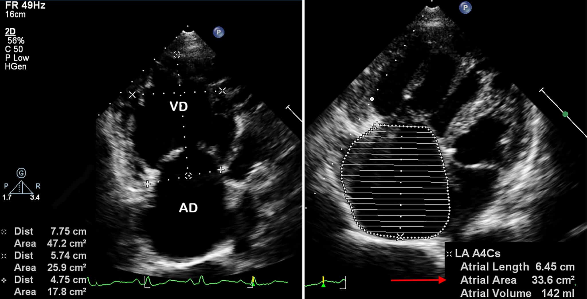 IDENTIFICAÇÃO ECOCARDIOGRÁFICA DA HIPERTENSÃO PULMONAR - Blog Ecope