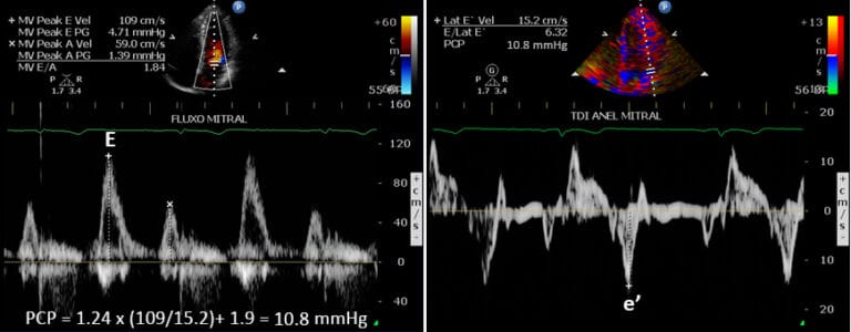 CÁLCULO DA PRESSÃO CAPILAR PULMONAR PELA ECOCARDIOGRAFIA - Blog Ecope