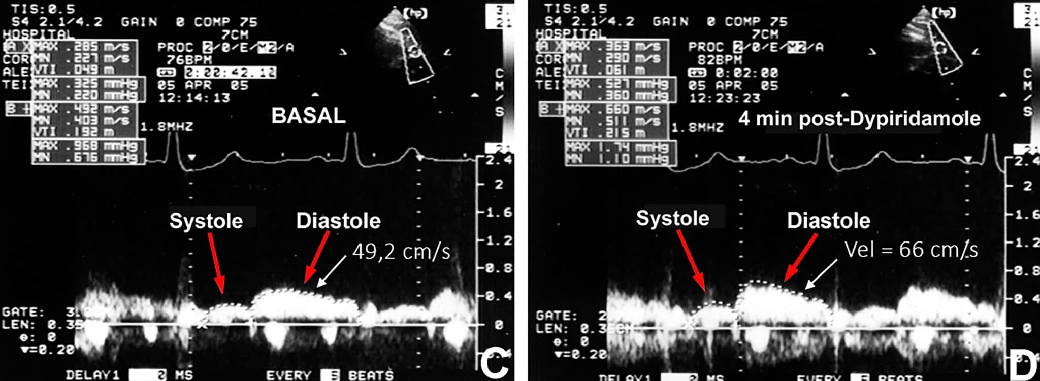 A ECOCARDIOGRAFIA EM CASOS ESPECIAIS – PARTE 3 - Blog Ecope