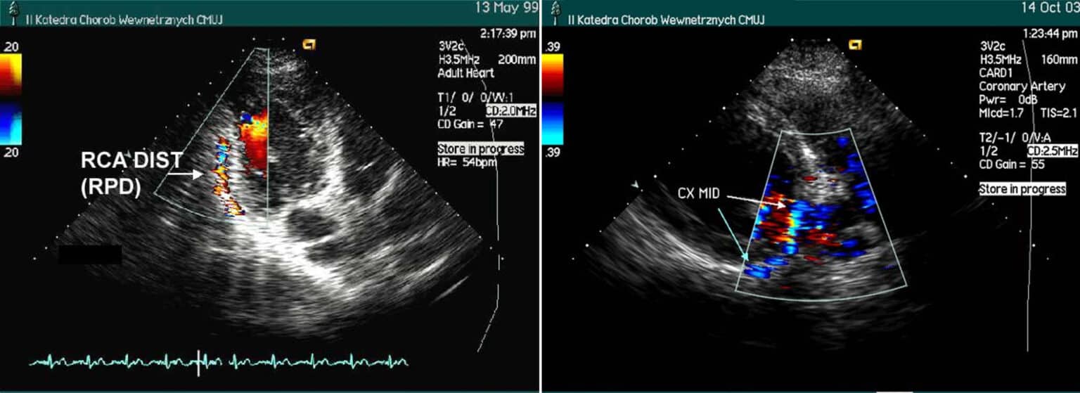 A ECOCARDIOGRAFIA EM CASOS ESPECIAIS – PARTE 1 - Blog Ecope