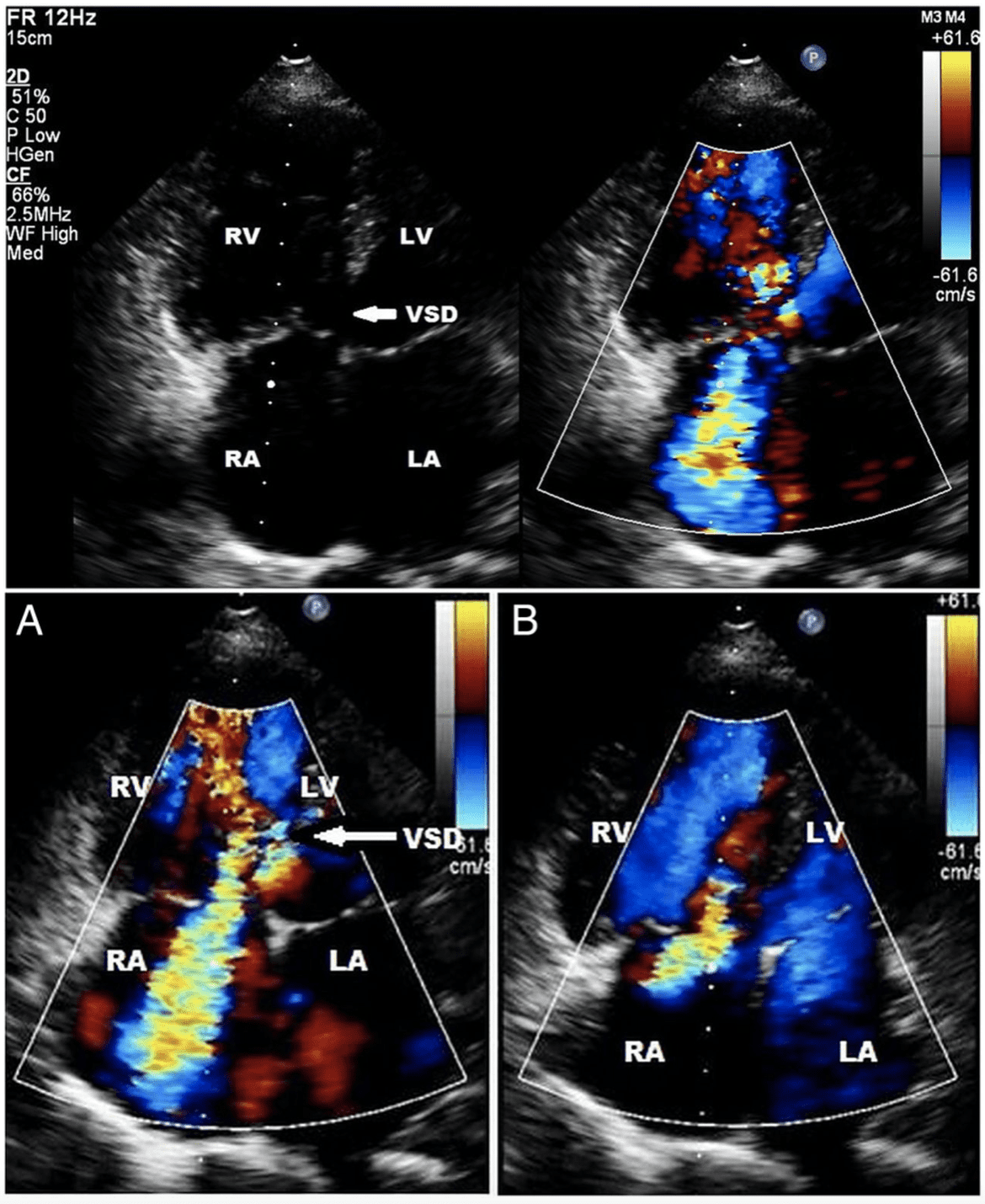 Defeito de Gerbode: Aspectos Ecocardiográficos. - Blog Ecope