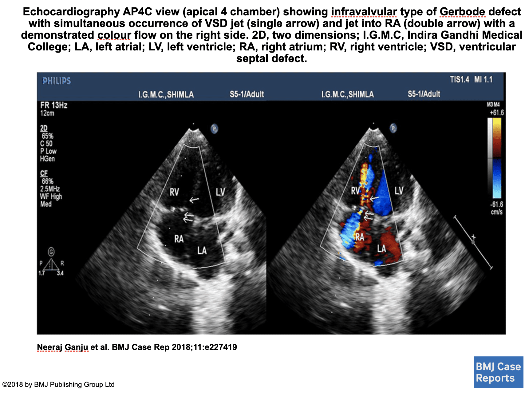 Defeito de Gerbode: Aspectos Ecocardiográficos. - Blog Ecope