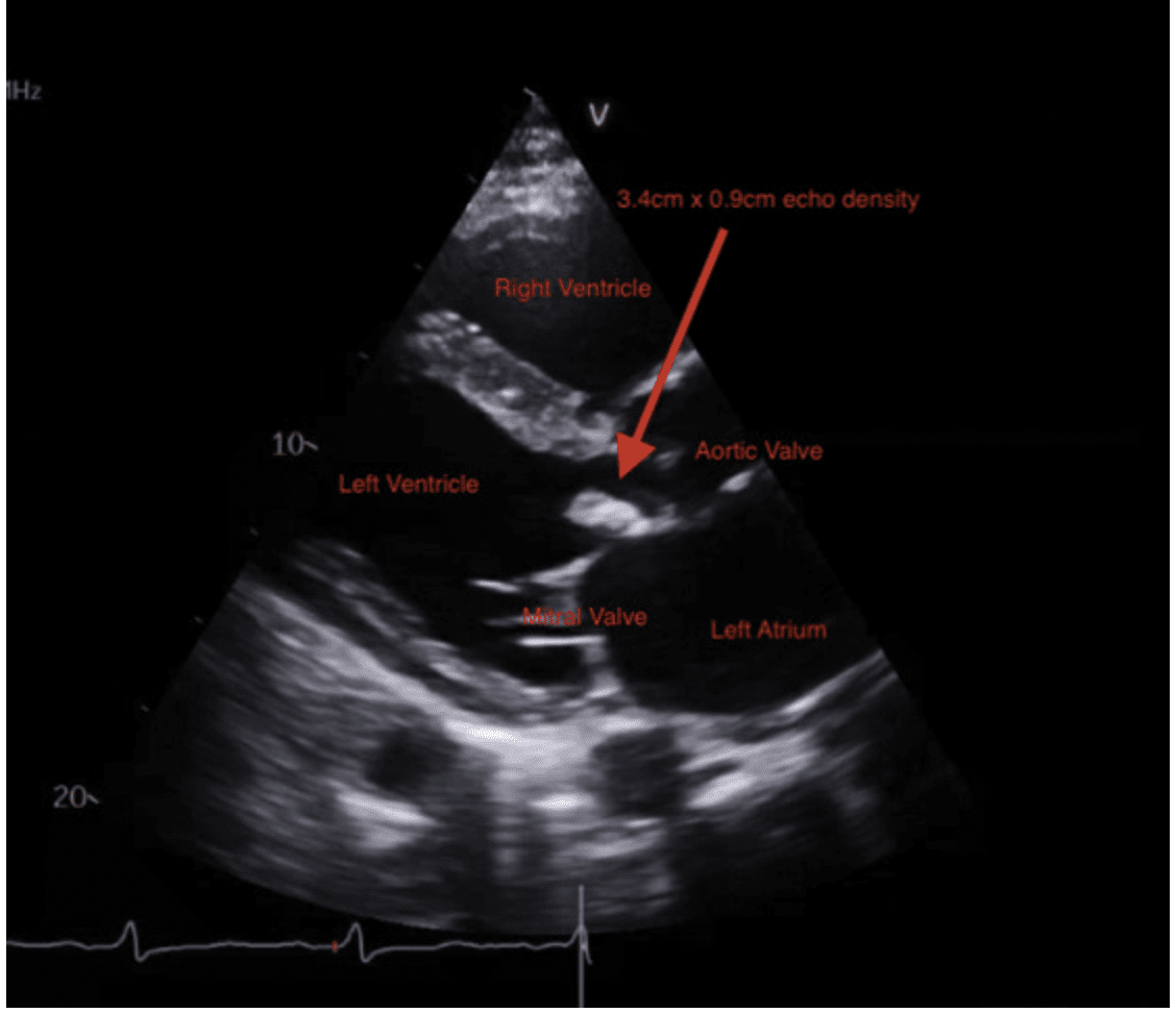 Hemodiálise e Calcificação Valvar: uma associação frequente ! - Blog Ecope