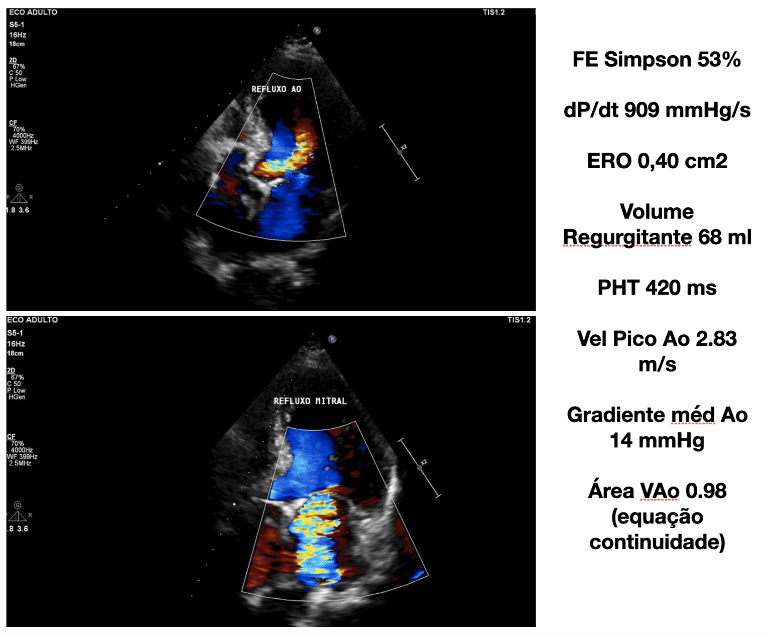 Novo Modelo de Quantificação Objetiva de Calcificação Valvar para ...