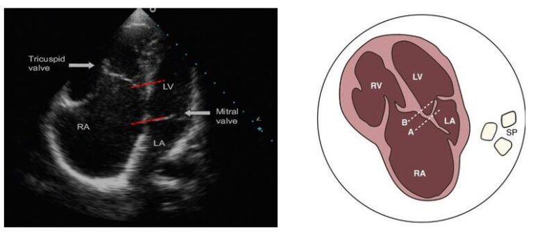 Anomalia de Ebstein: aspectos ecocardiográficos - Blog Ecope