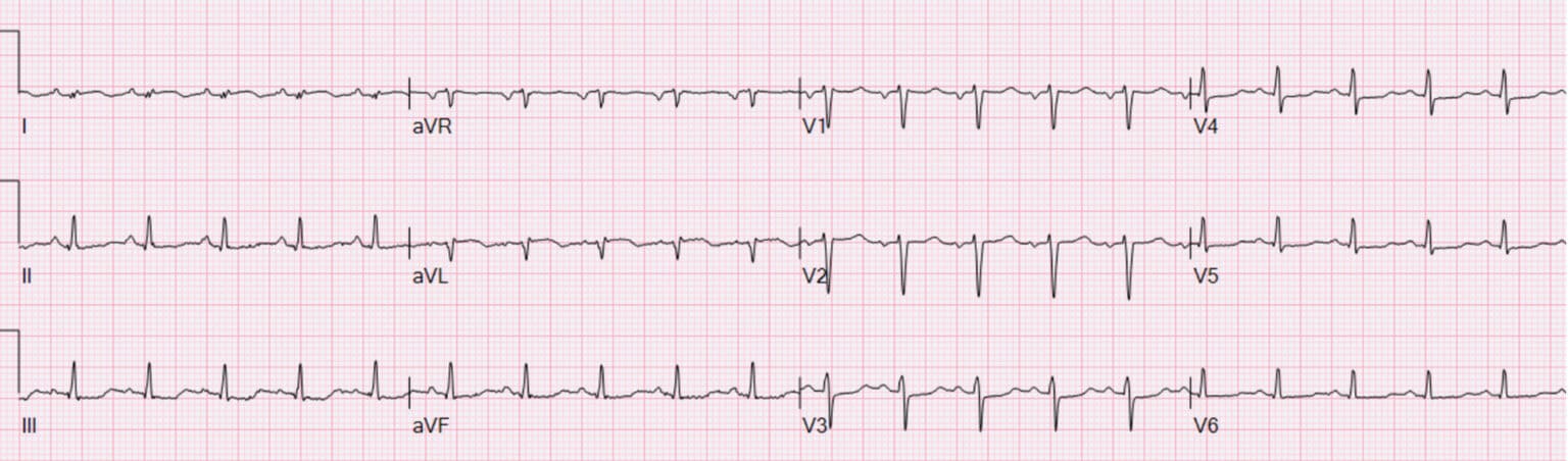 Annulus Reversus: apenas um fator mecânico ? - Blog Ecope