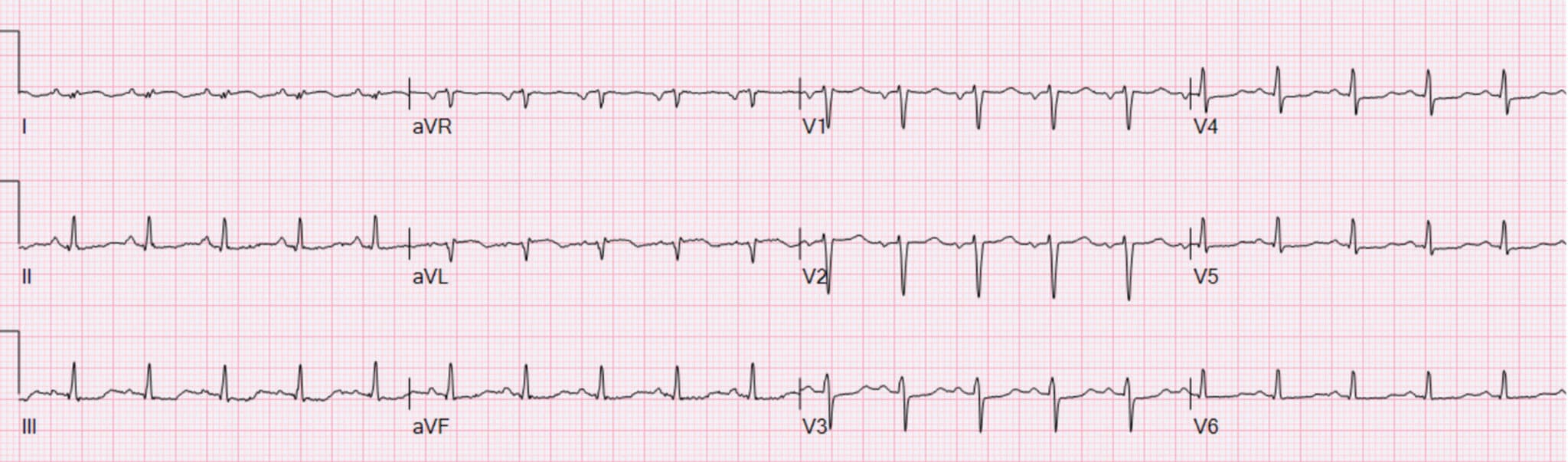Annulus Reversus: apenas um fator mecânico ? - Blog Ecope