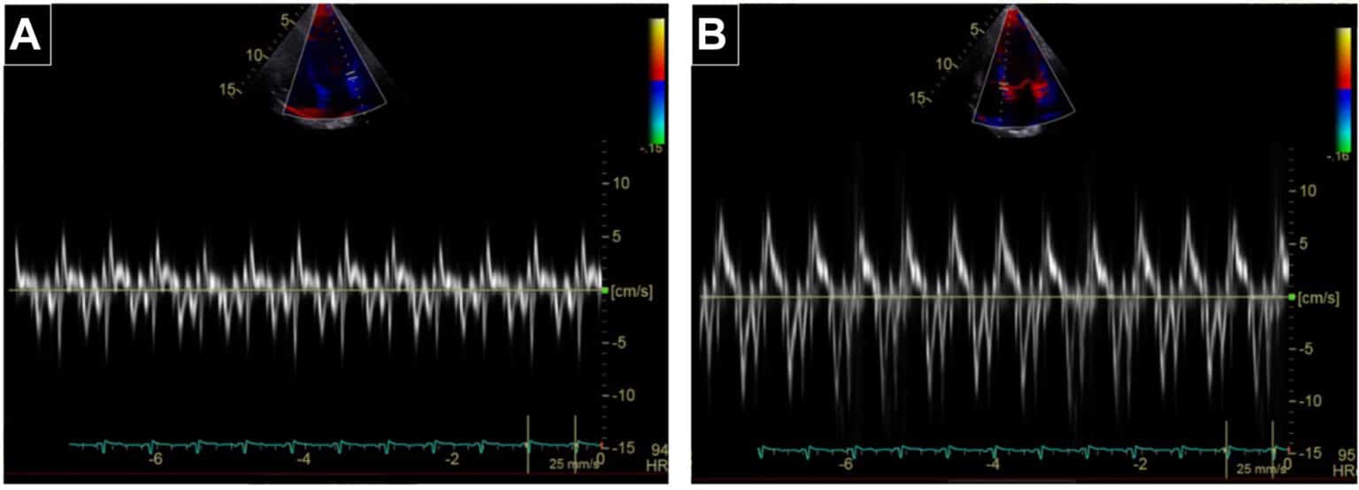 Annulus Reversus: apenas um fator mecânico ? - Blog Ecope
