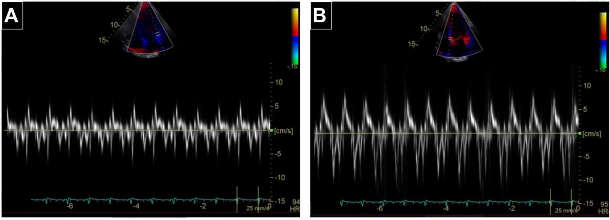Annulus Reversus: apenas um fator mecânico ? - Blog Ecope