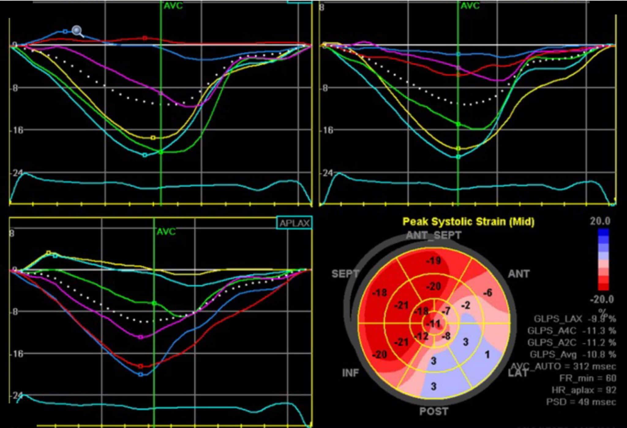 Annulus Reversus: apenas um fator mecânico ? - Blog Ecope