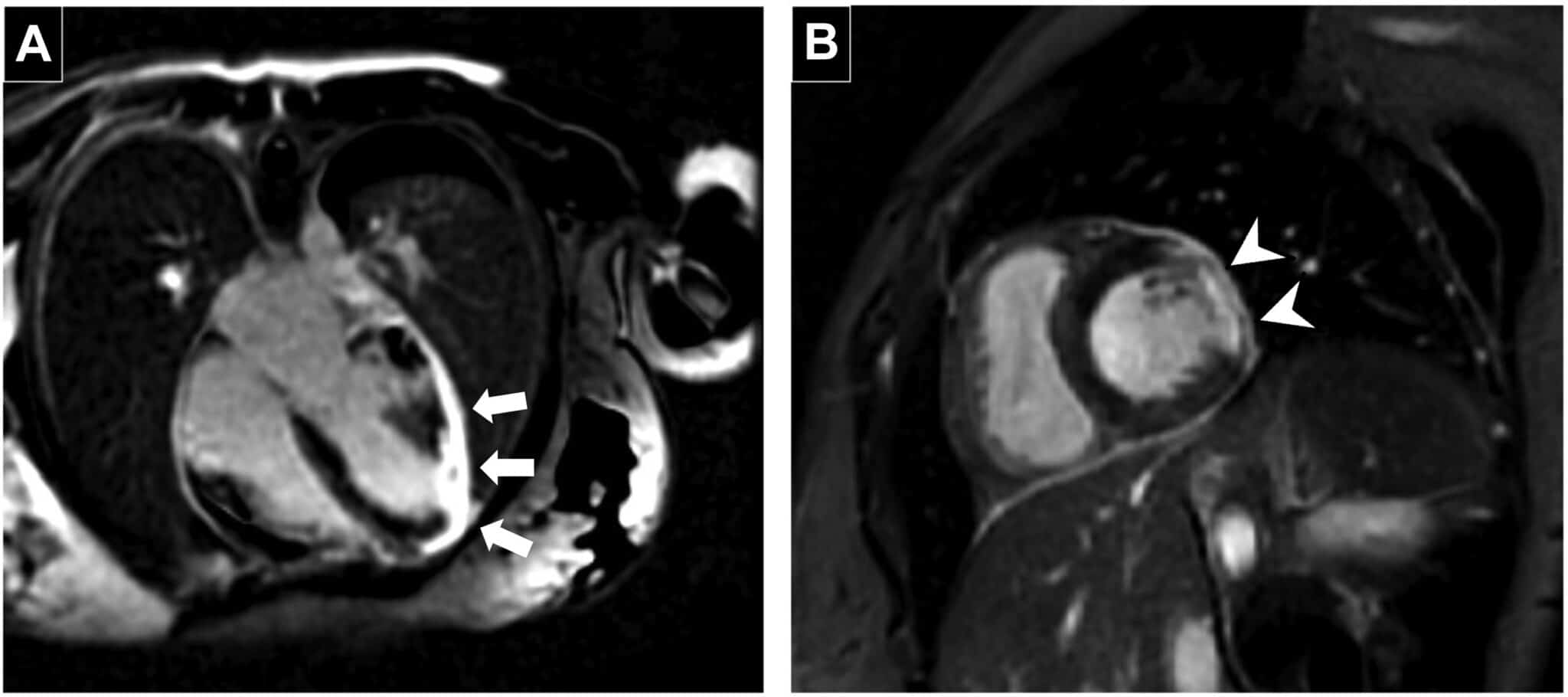 Annulus Reversus: apenas um fator mecânico ? - Blog Ecope