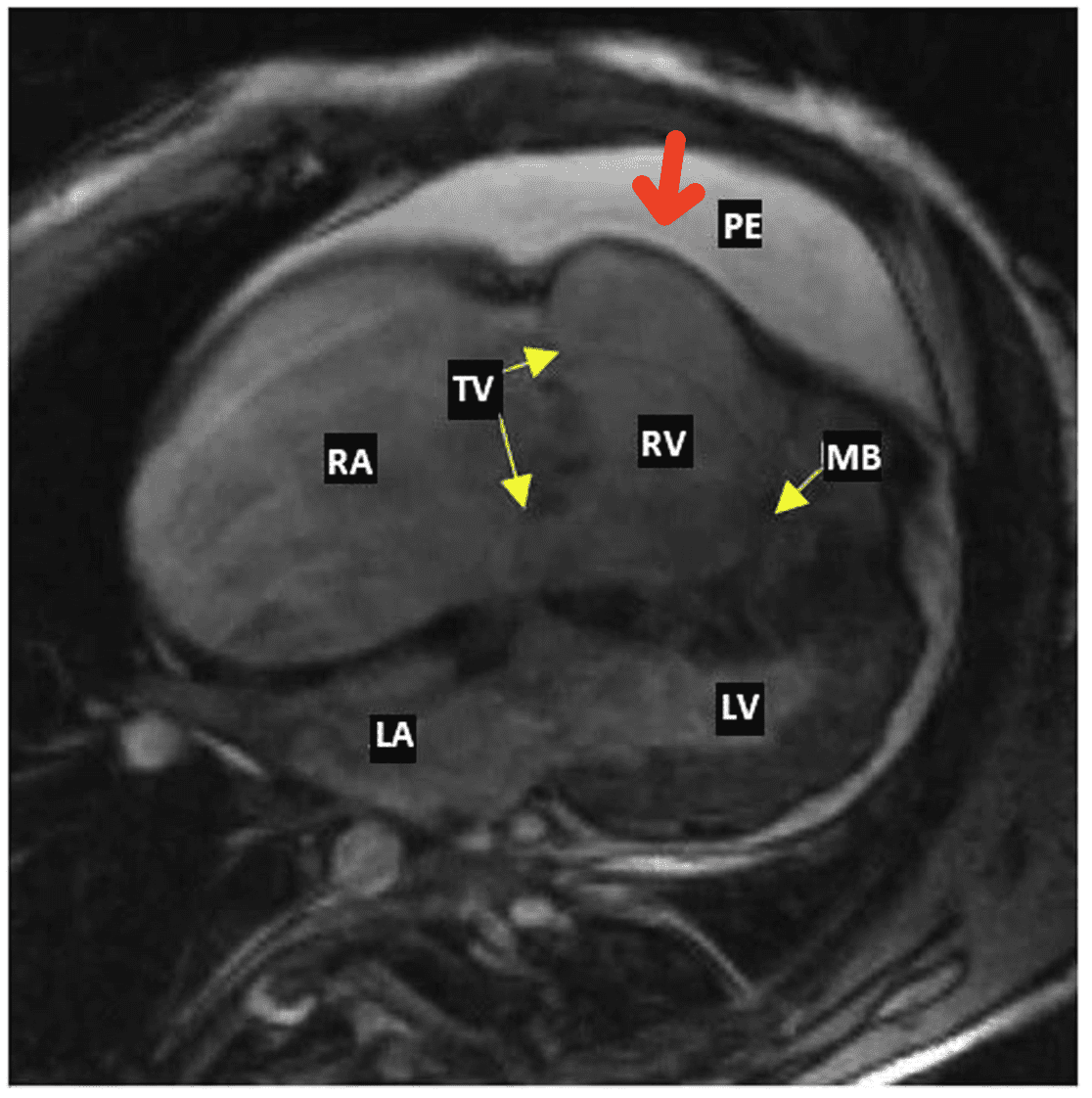 Anomalia de Uhl: já ouviu falar? - Blog Ecope