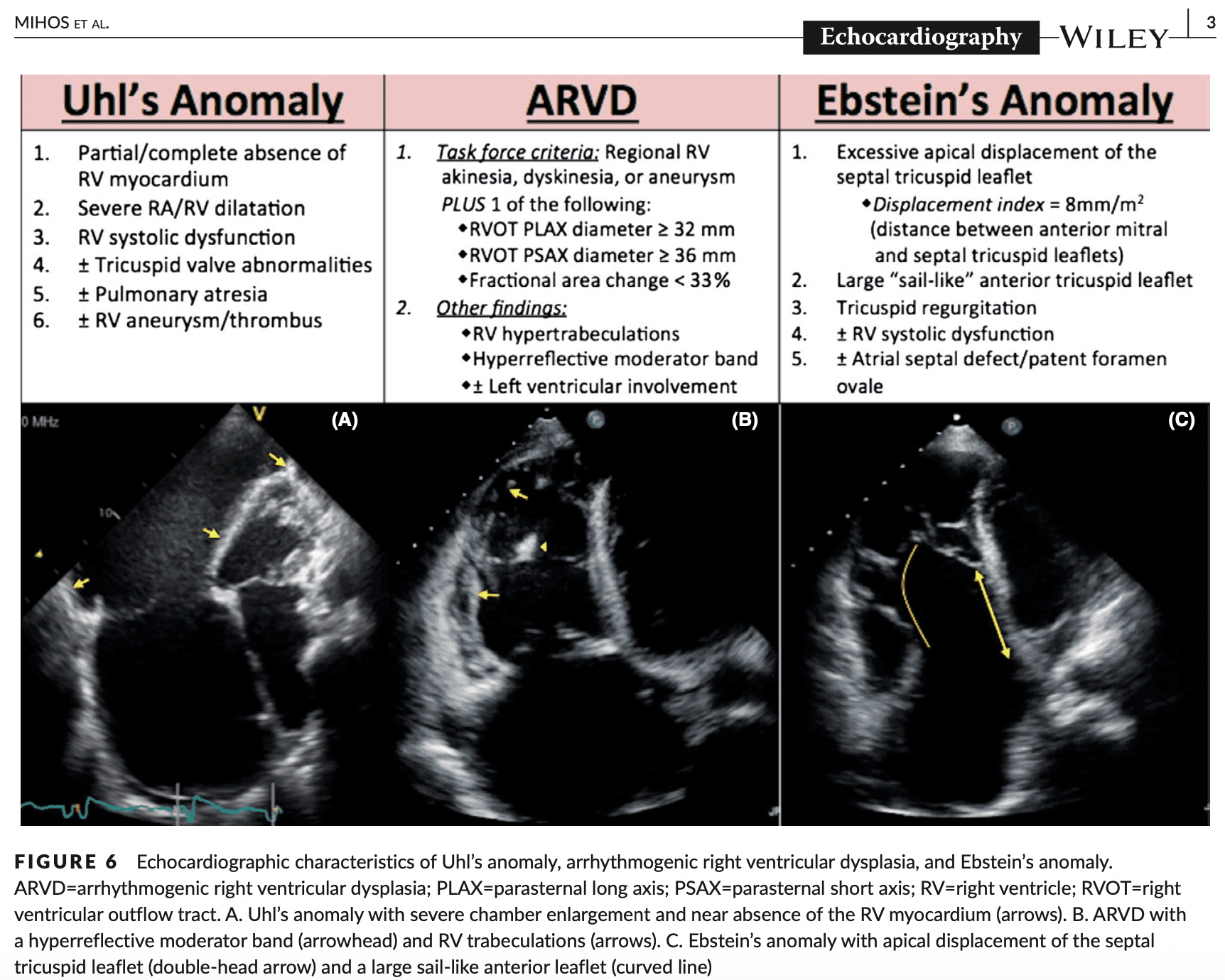 Anomalia de Uhl: já ouviu falar? - Blog Ecope