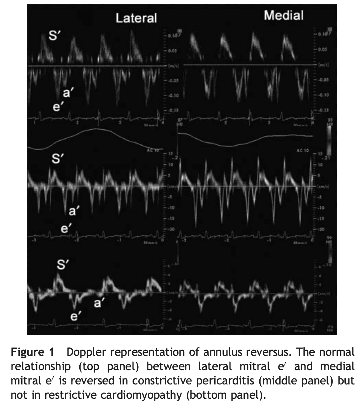 Annulus Reversus: apenas um fator mecânico ? - Blog Ecope