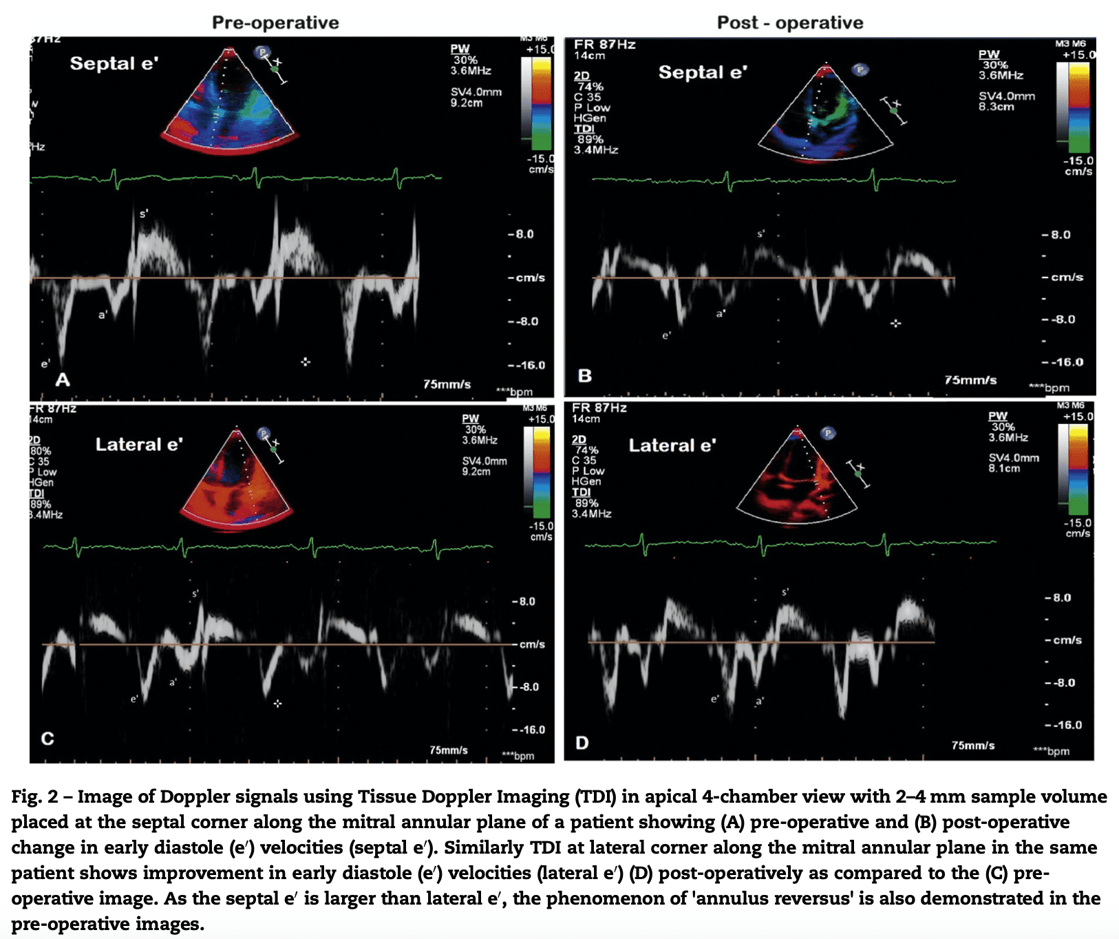 Annulus Reversus: apenas um fator mecânico ? - Blog Ecope