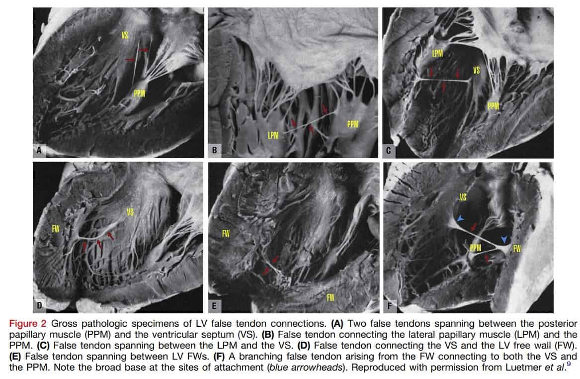 Falso Tendão do Ventrículo Esquerdo: aspectos ecocardiográficos - Blog ...