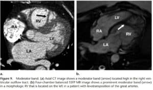 Banda Moderadora: aspectos anatômicos e funcionais - Blog Ecope