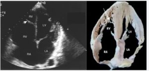 Banda Moderadora: aspectos anatômicos e funcionais - Blog Ecope