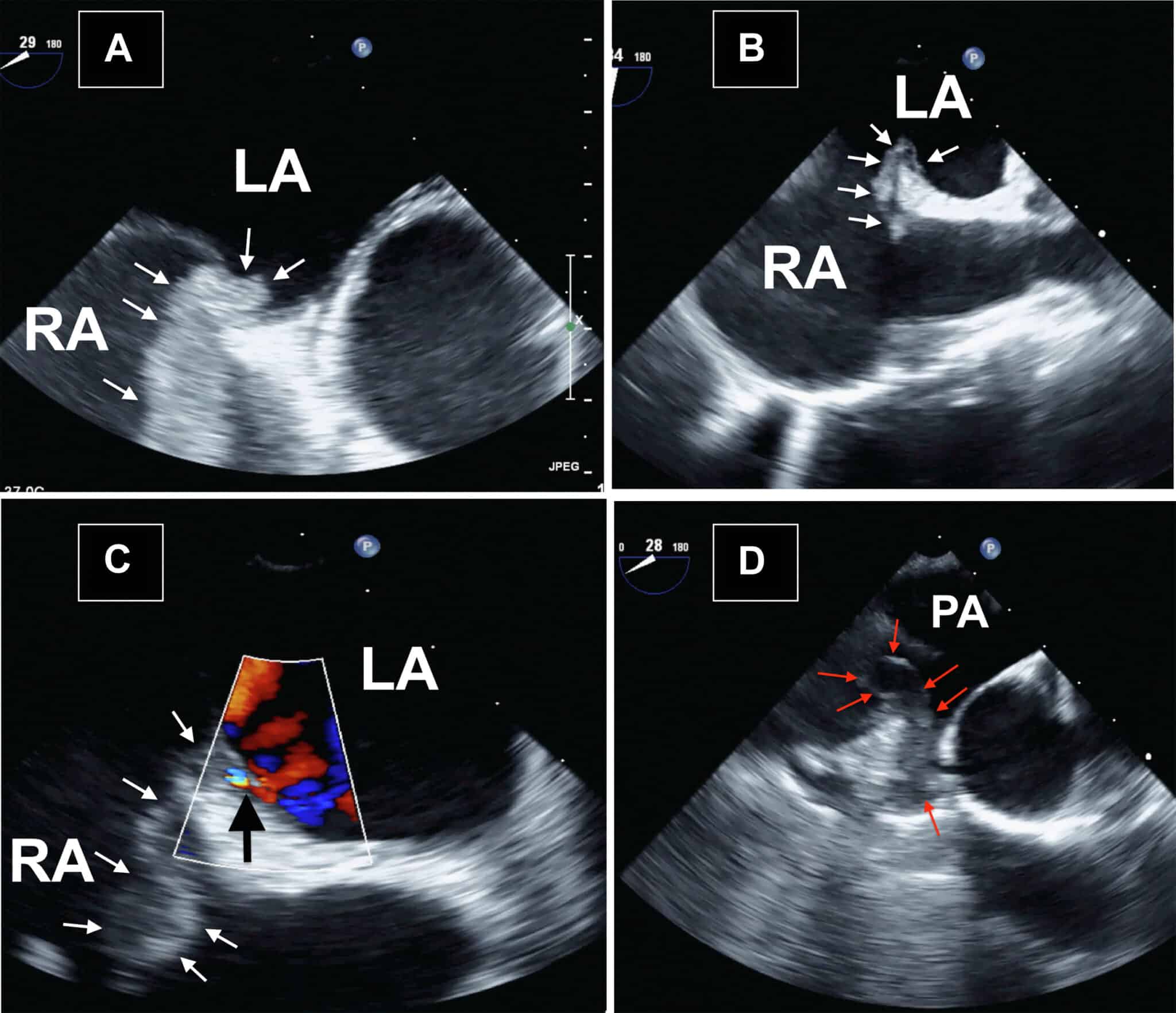 Trombo em Trânsito: Papel da Ecocardiografia - Blog Ecope