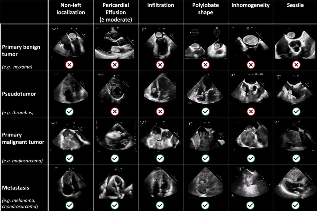 Marcadores Ecocardiográficos para o Diagnóstico de Massas Cardíacas ...