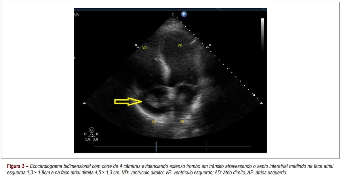 Trombo em Trânsito: Papel da Ecocardiografia - Blog Ecope