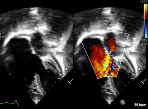 Trabalho de Conclusão de Curso: Dupla Via de Saída do Átrio Direito ...