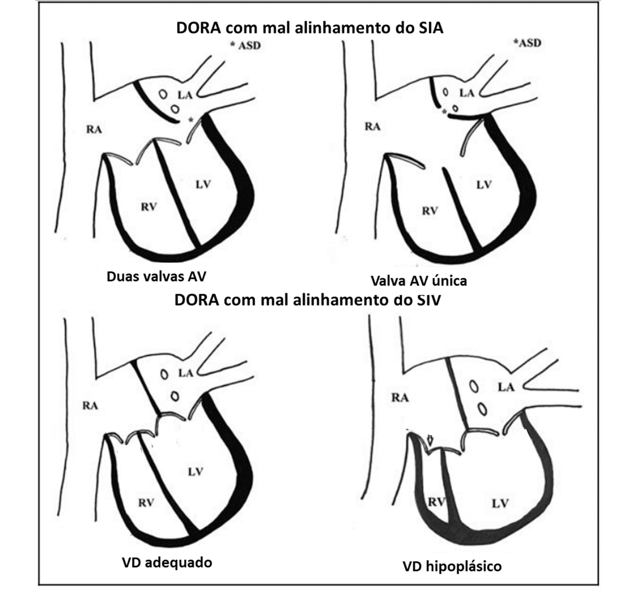 Trabalho de Conclusão de Curso: Dupla Via de Saída do Átrio Direito Associada a Defeito do Septo ...